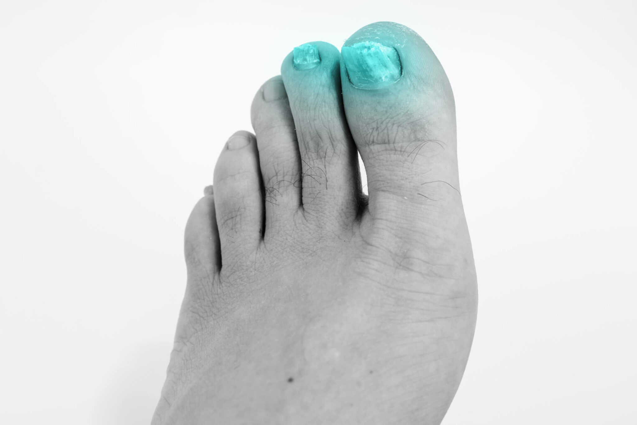 What Causes Thick Toenails and How to Fix Them: Unveiling the Mystery