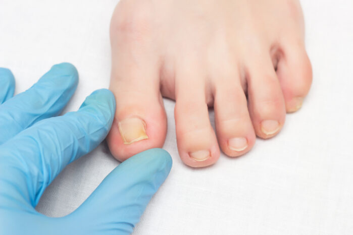 How to Cut Your Toenails: Stop Making These Mistakes when Clipping Your ...