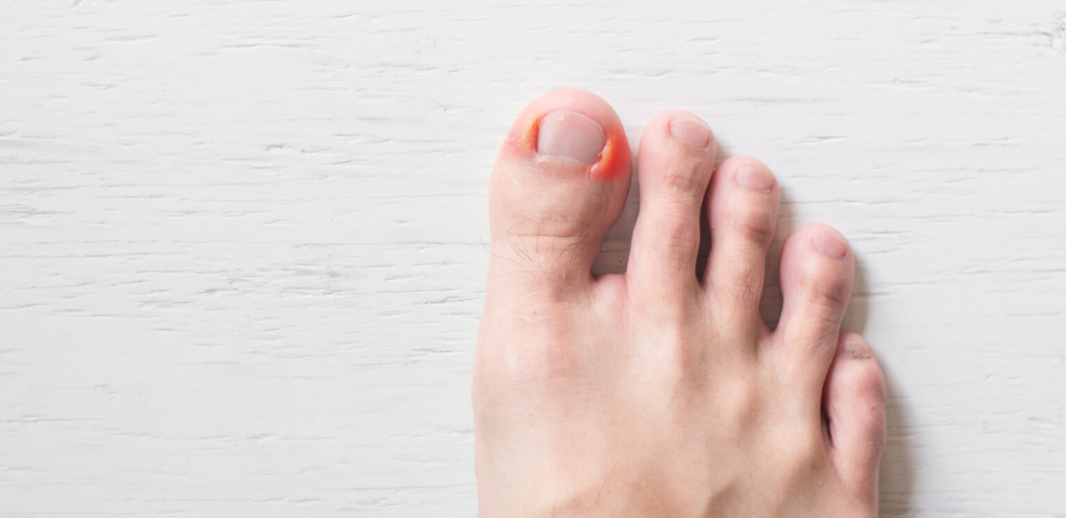Fix your Ingrown Toenails: Unlock your Foot Freedom Today